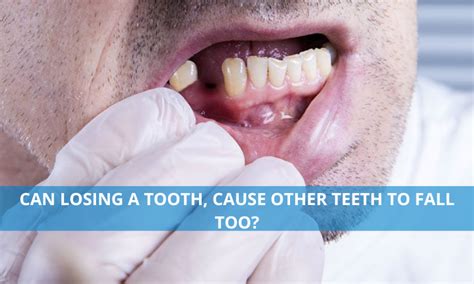 Can Losing A Tooth Cause Other Teeth To Fall Too