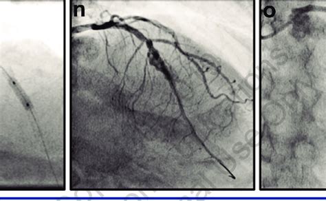 CONTINUED Angiographic Still Sequence Of The Angioplasty Procedure Download Scientific