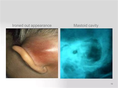 Complications Of Chronic Otitis Media Pptx