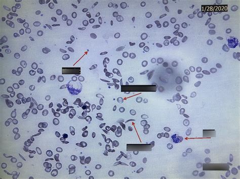 Sickle Cell Anemia Slide Diagram Quizlet