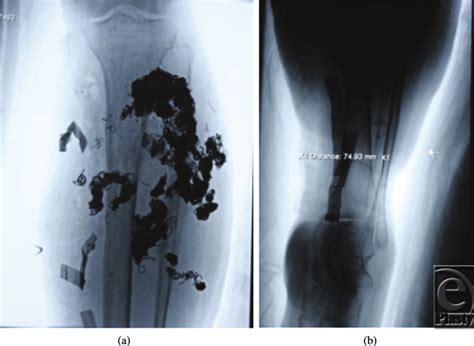 Angiogram After Our First Case Demonstrating Residual Coils And