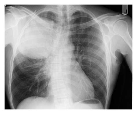 Chest X Ray Rt Upper Lobe Mass Download Scientific Diagram