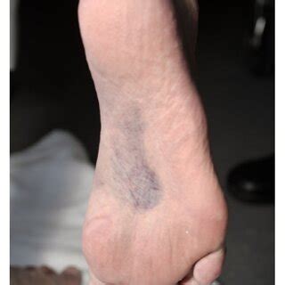 Palpable Purpuric Rash And Confluent Ecchymoses On Both Legs And In Download Scientific