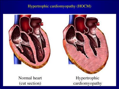 Hypertrophic Cardiomyopathy Symptoms Causes Forms And Treatment The