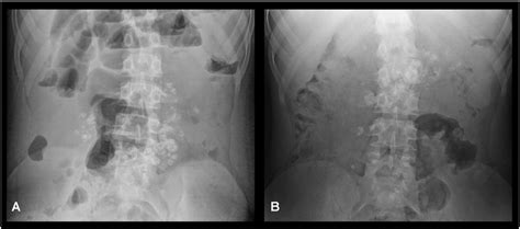 A Plain Abdomen X Ray Showing Multiple Calcified Mesenteric Lymph Download Scientific Diagram