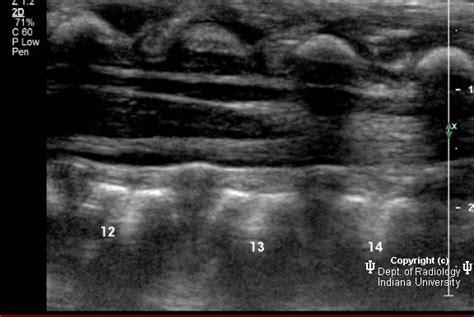 Neuroradiology On The Net Tethered Cord