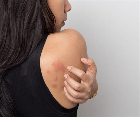 Papular Urticaria Causes Symptoms And Management
