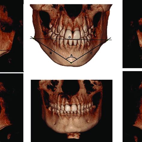 Mandibular Morphometry For The Gender Determination Upper Row For Download Scientific Diagram