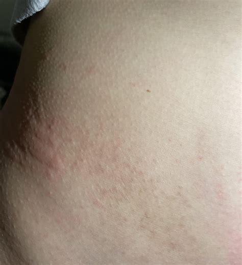 Post Scabies Rscabies