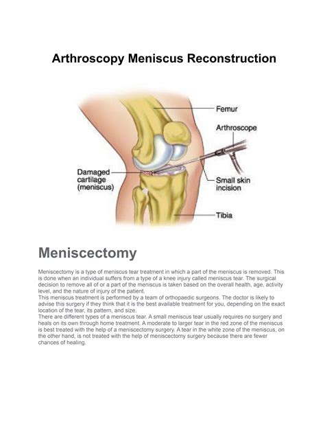 Arthroscopy Meniscus Reconstruction By Drkumrvishal Issuu