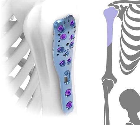 Humerus Proximal 3 5mm Astrolabe