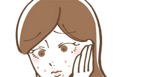 여드름에 숨은 켈로이드 잘못하면 평생 고민