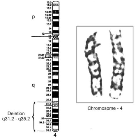 Pdf A Comprehensive Review Of Chromosome 4q Deletion Syndrome