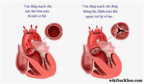 Bệnh Van động Mạch Chủ Khái Niệm Nguyên Nhân Triệu Chứng Phòng Ngừa