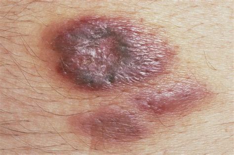 Kaposis Sarcoma Nhsuk