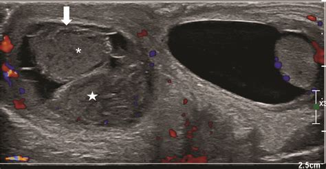 Imaging Testicular Torsion Applied Radiology