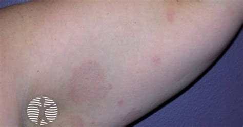 Granuloma Annulare Image