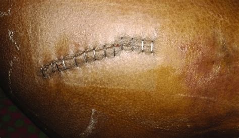 Post Operative Day 7 Presentation Of The Incision Site Of Right Hip Of Download Scientific