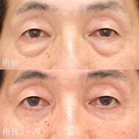 ハムラ法の症例写真 Ι 執刀医：金子 貴則 Ι 美容整形なら水の森美容クリニック