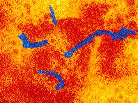 What Does Measles Actually Do Science Aaas