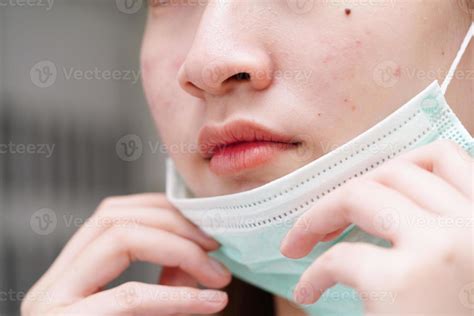 Acne Pimple And Scar On Skin Face Disorders Of Sebaceous Glands