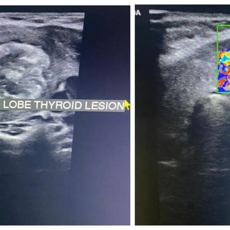 A Ultrasound Of The Thyroid Showing Enlargement Of The Left Lobe Of