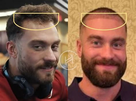 Chris Bumstead Cbum Hair Transplant Hair Restoration Analysis