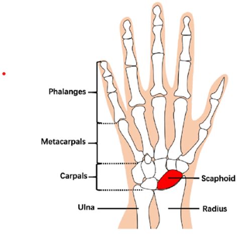Scaphoid Fracture Classification