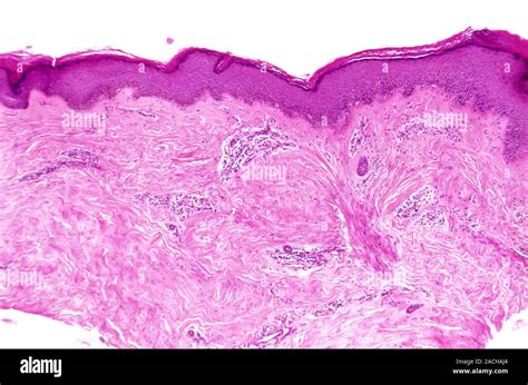 Keratoacanthoma Light Micrograph Of A Section Through A