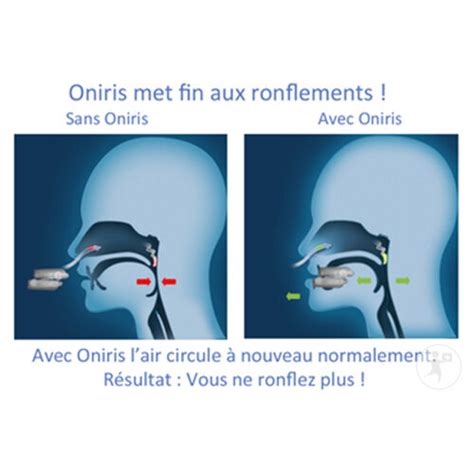 Oniris Orthèse Anti Ronflement Newpharma