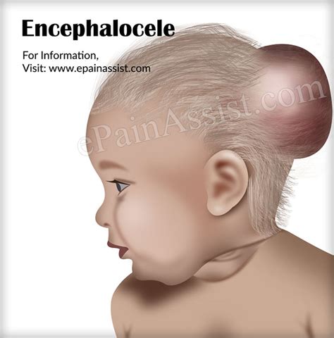 What Is Encephalocele Causes Symptoms Treatment Recovery Outcome