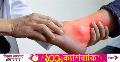 How To Manage Gout During Ramadan The Daily Star