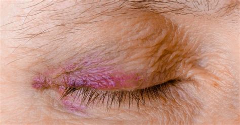 Equimosis Definici N Causas Y Tratamiento Salud Tudo