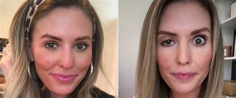 Can Botox Injections Go Wrong An Experts Perspective