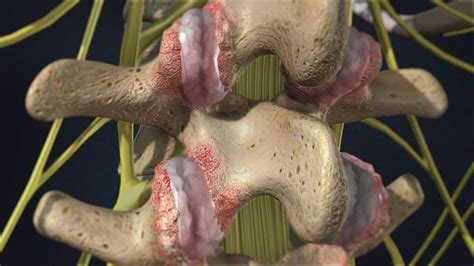 Synovial Cyst Of The Spine Causes Symptoms And Treatment