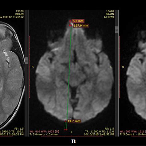 Use Of Parallel Imaging Technique For Geometric Distortion Artifacts Download Scientific