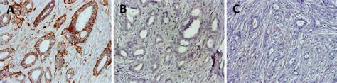 Immunohistochemical Staining Of An Invasive Tubular Carcinoma For Cd44
