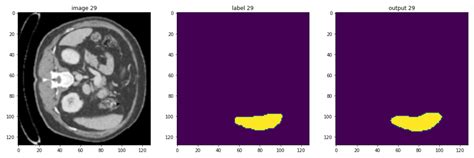 Liver Segmentation Part 4 4 Train The Model Pycad