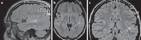 Sagittal A Axial B And Coronal C Flair Weighted Mri
