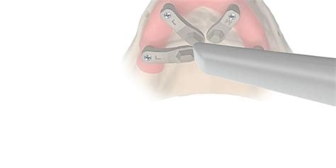 Photogrammetry Systems Aa Dental Design