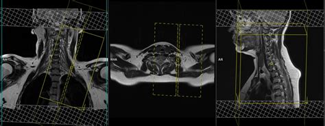 Mri Mrinext