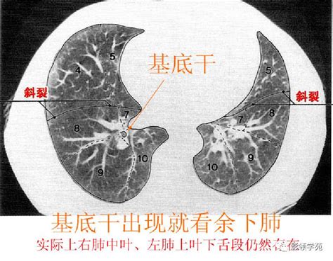 肺不张影像表现 搜狐大视野 搜狐新闻