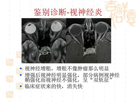 视神经鞘脑膜瘤的影像诊断 福建医科大学附属第一医院 影像科 郑婉静 ppt download