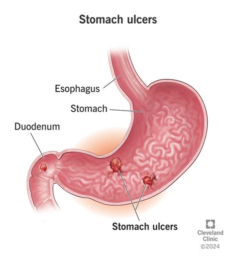 Small Intestine Ulcer Treatment