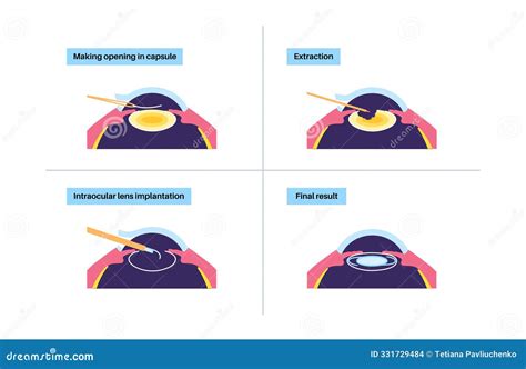 Cataract Surgery Poster Stock Illustration Illustration Of Crystalline 331729484