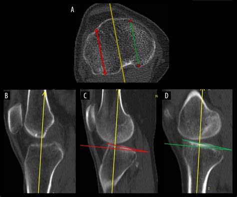 Association Of Femoral Trochlear Dysplasia And Tibiofemoral Joint Morphology In Adolescent Pmc