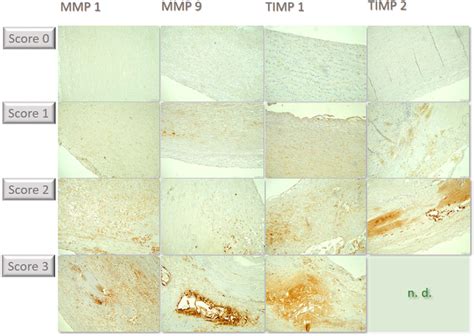 Figure 2 From The Role Of Matrix Metalloproteinases In Thoracic Aortic