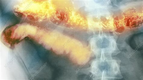 Ulcerative Colitis Animated X Ray Stock Video Clip K0122699