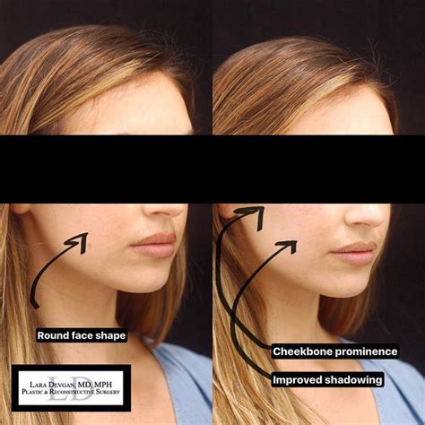 Cheekbone Augmentation For A Gorgeous Model 👸🏻👸🏻👸🏻 This Is A Subtle