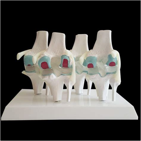 Buy FHUILI Knee Joint Model Human Lesion Knee Anatomy Model 4 Stage